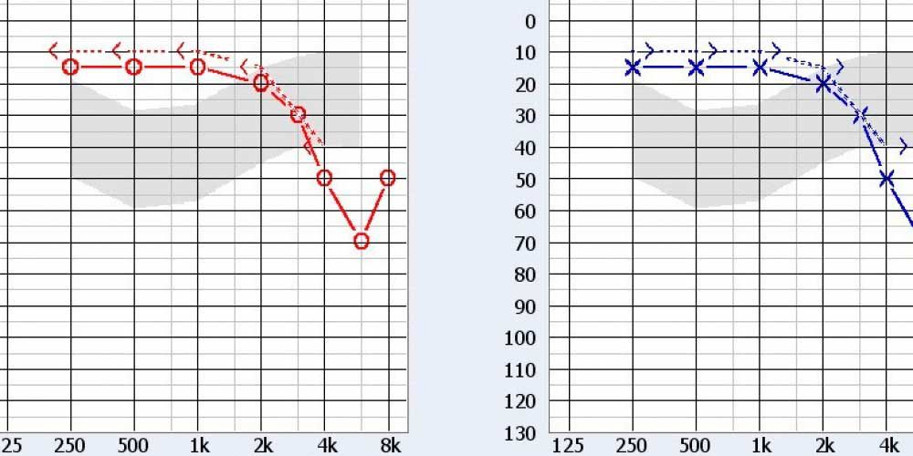 El audiograma - Comaudi